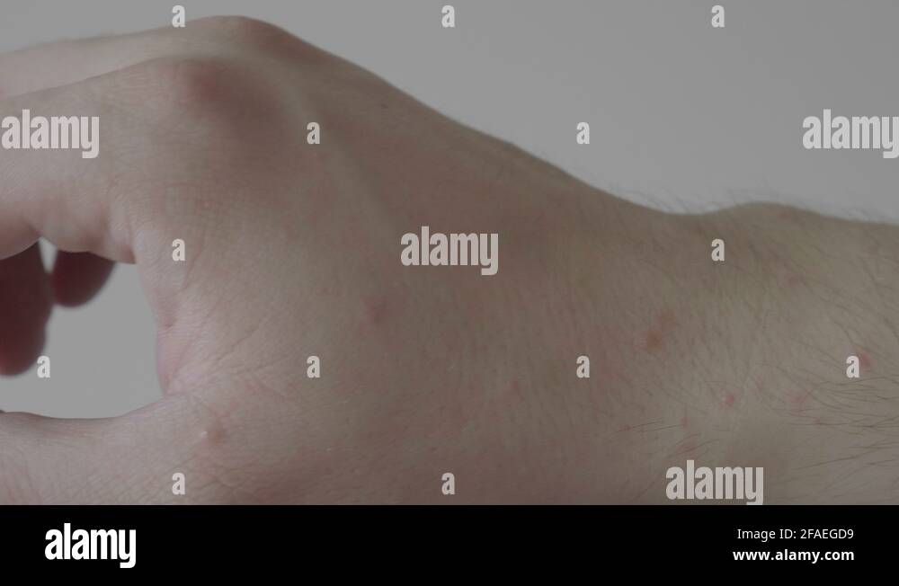 Sensitive scratchy skin of teenager showing his arm with redness rash ...