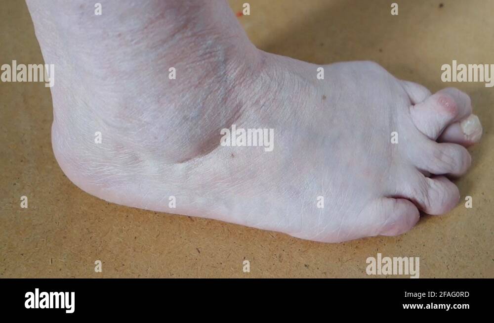 Valgus Deformity of Female Leg Due (Hallux Valgus) and Weakness of ...