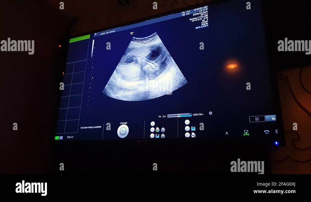 Fetal Ultrasound screen showing baby in womb Stock Video Footage - Alamy