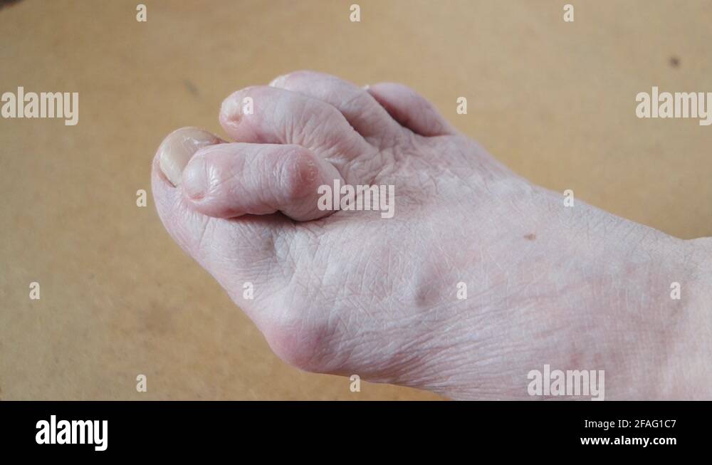 Valgus Deformity of Female Leg Due (Hallux Valgus) and Weakness of ...