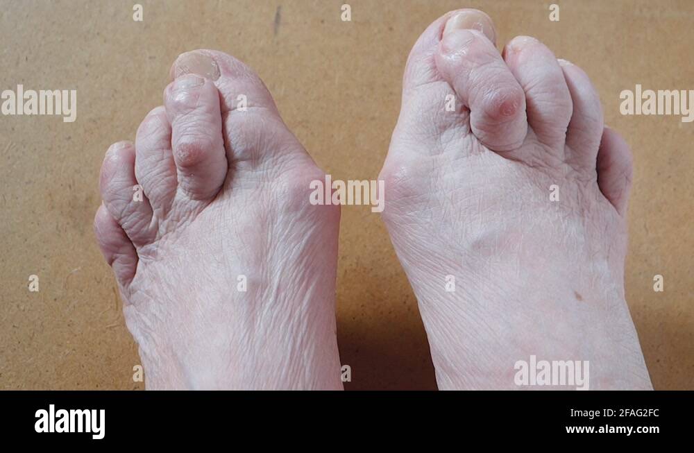 Valgus Deformity of Female Leg Due (Hallux Valgus) and Weakness of ...