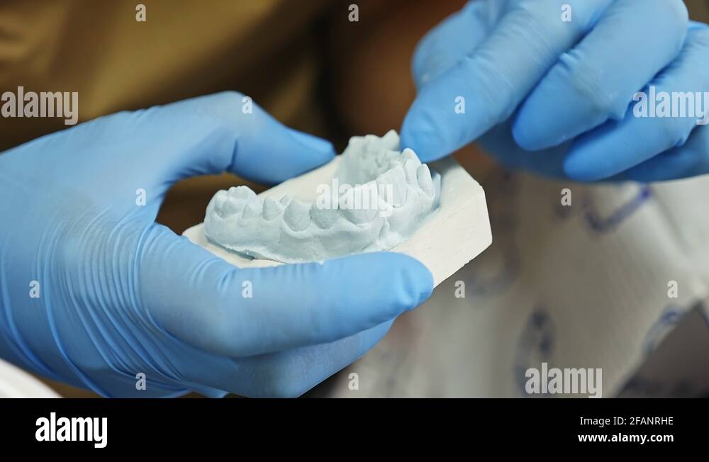 The plaster model of the mandible in the hands of an orthodontist Stock ...