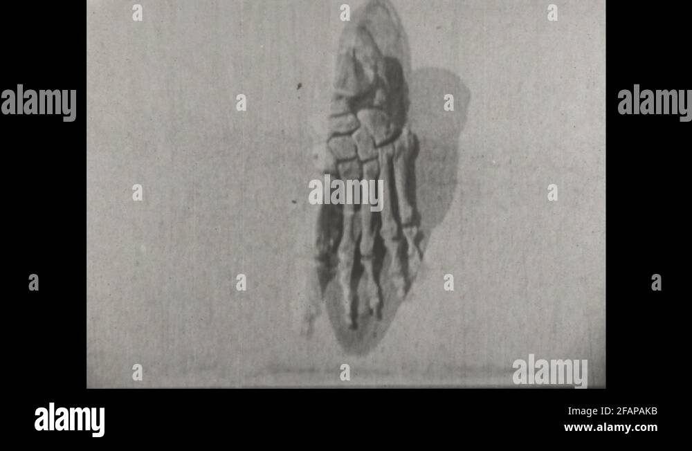 Foot pathology Stock Videos & Footage - HD and 4K Video Clips - Alamy