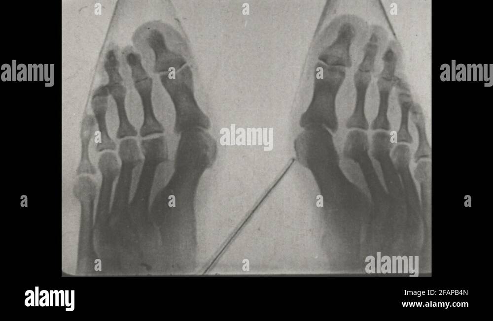 1930s: UNITED STATES: distorted, painful and ugly feet on x-ray ...