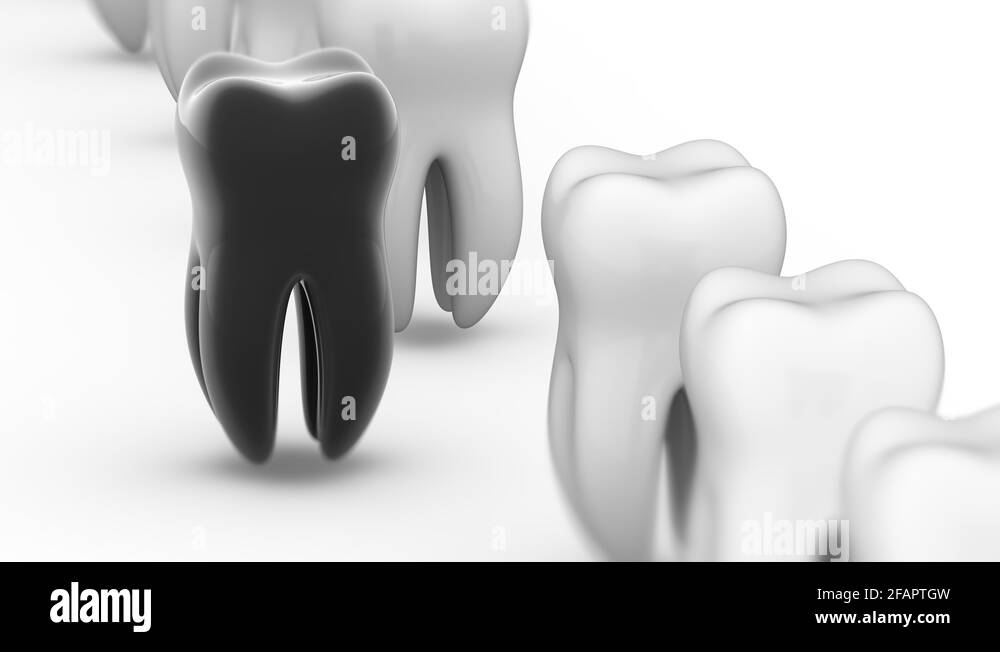 Decayed wisdom tooth Stock Videos & Footage - HD and 4K Video Clips - Alamy