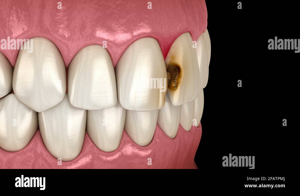 Teeth caries Stock Videos & Footage - HD and 4K Video Clips - Alamy