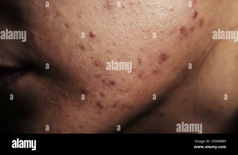 Severe acne Stock Videos & Footage - HD and 4K Video Clips - Alamy