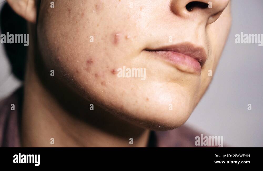 Skin problem face woman Stock Videos & Footage - HD and 4K Video Clips ...