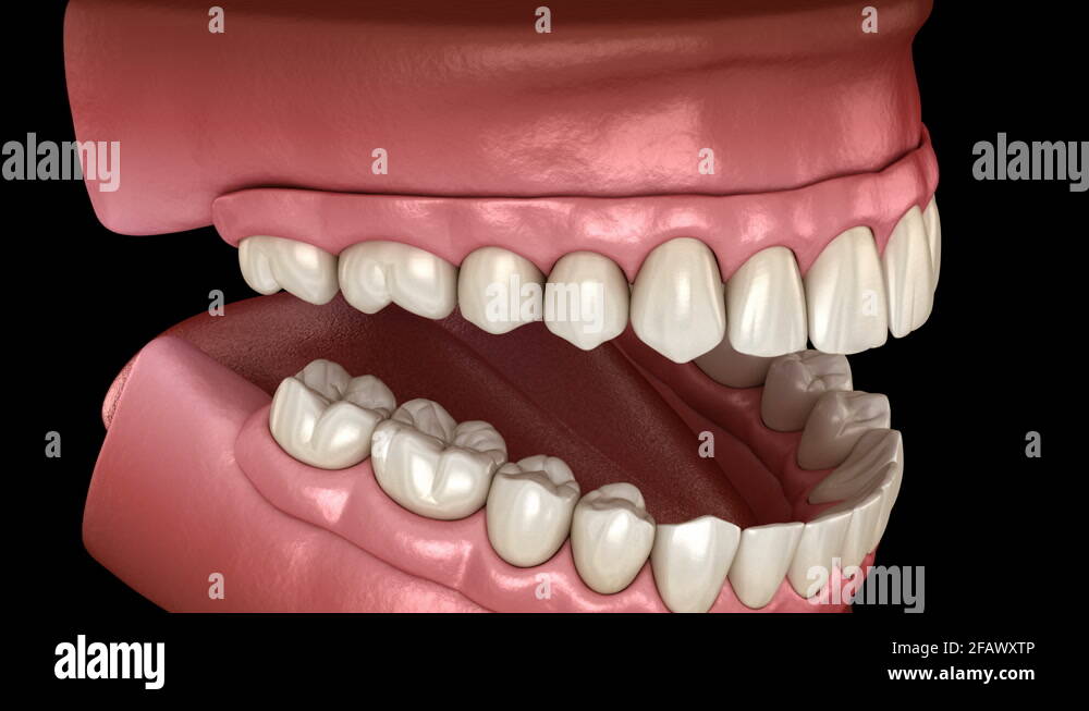 Maxillary prosthesis All on 4 system supported by implants Stock Video ...