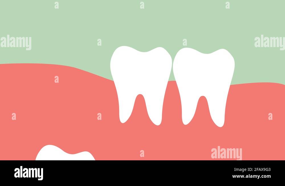 inflammation of wisdom tooth ( angular or mesial impaction Stock Video ...
