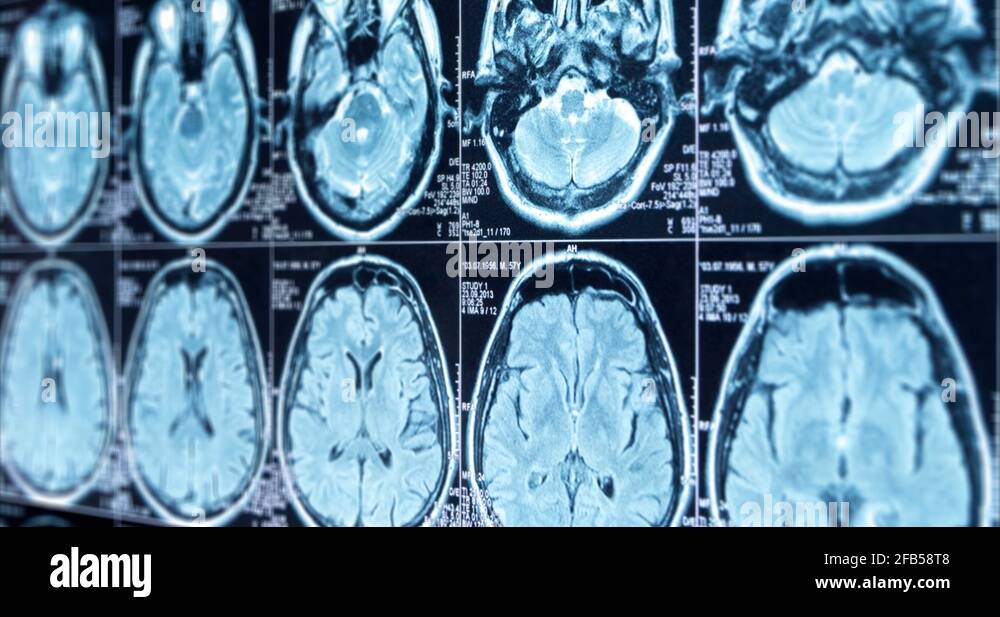 MRI scan of the brain close up scroll up, looped Stock Video Footage ...