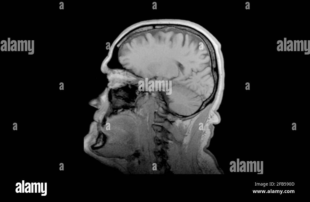 Magnetic resonance imaging of the brain from the side, MRI, looped ...