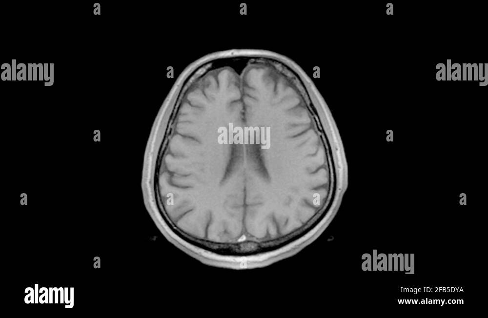 Mri magnetic resonance imaging brain Stock Videos & Footage - HD and 4K ...