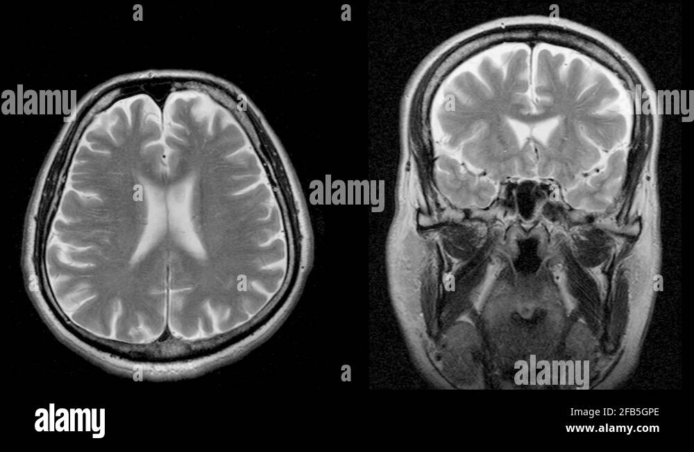 Magnetic resonance scan of the head top and front, MRI, looped Stock ...