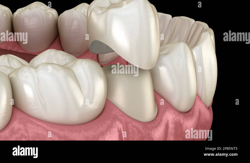 Premolar tooth Stock Videos & Footage - HD and 4K Video Clips - Alamy