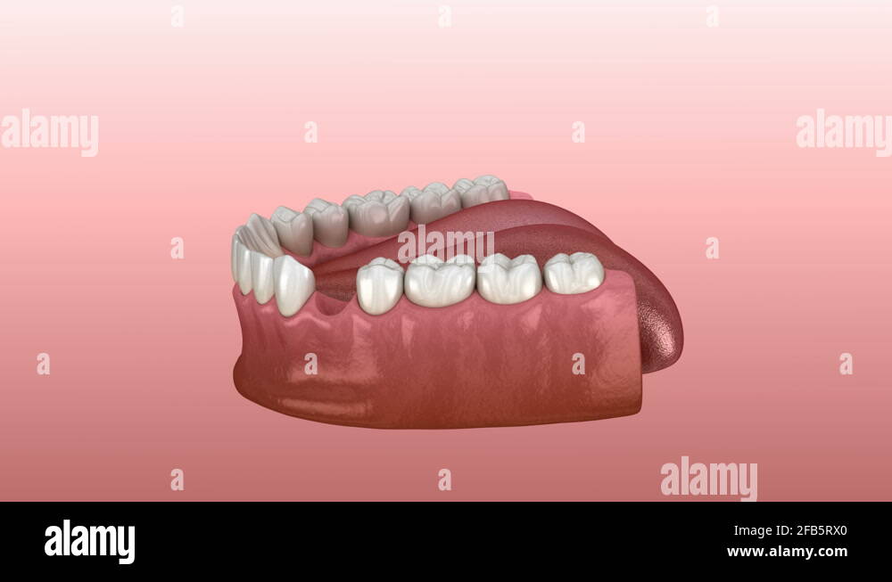 Implantation process in details: 3D animation of Drilling, implantat ...
