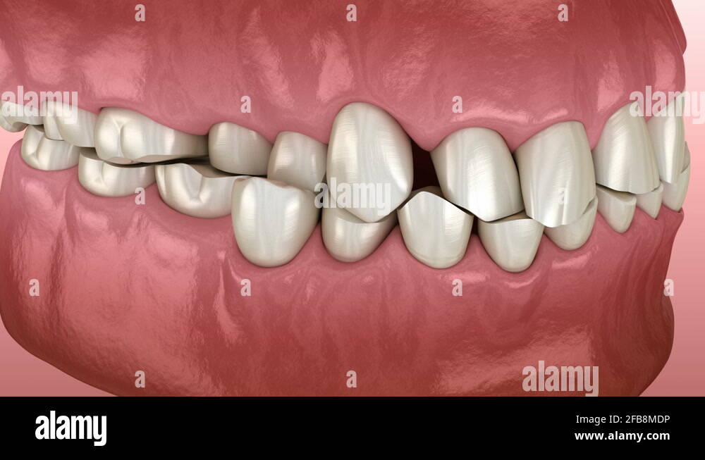 Loss of tooth enamel Stock Videos & Footage - HD and 4K Video Clips - Alamy