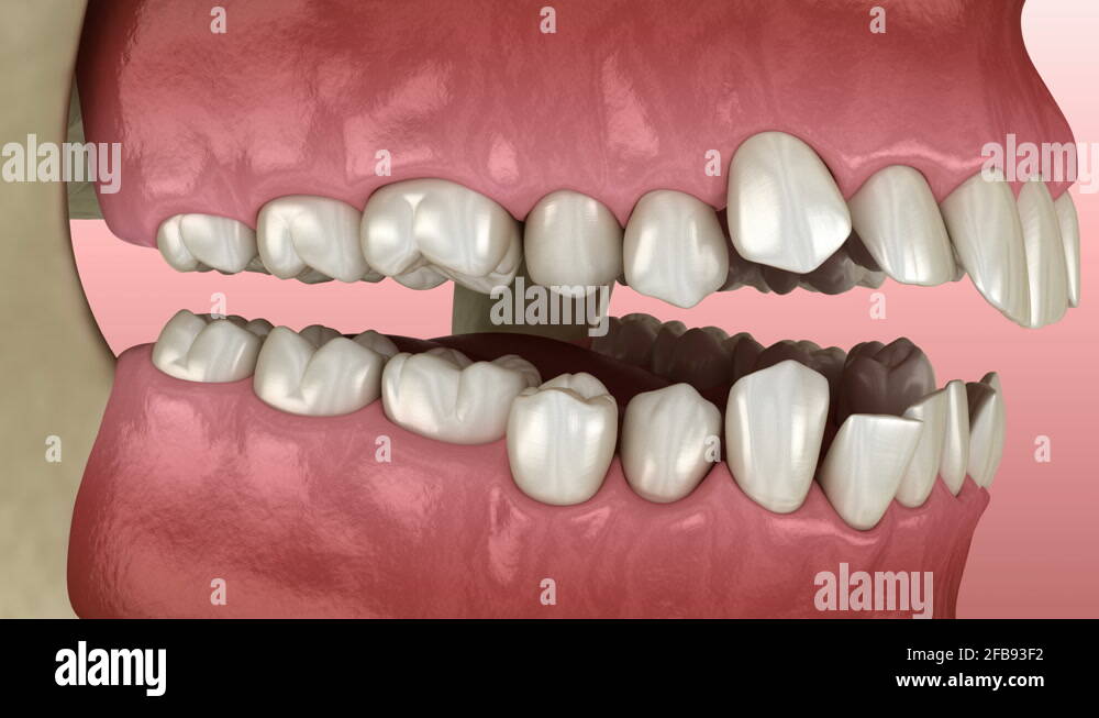 Orthodontic teeth alignment Stock Videos & Footage - HD and 4K Video ...