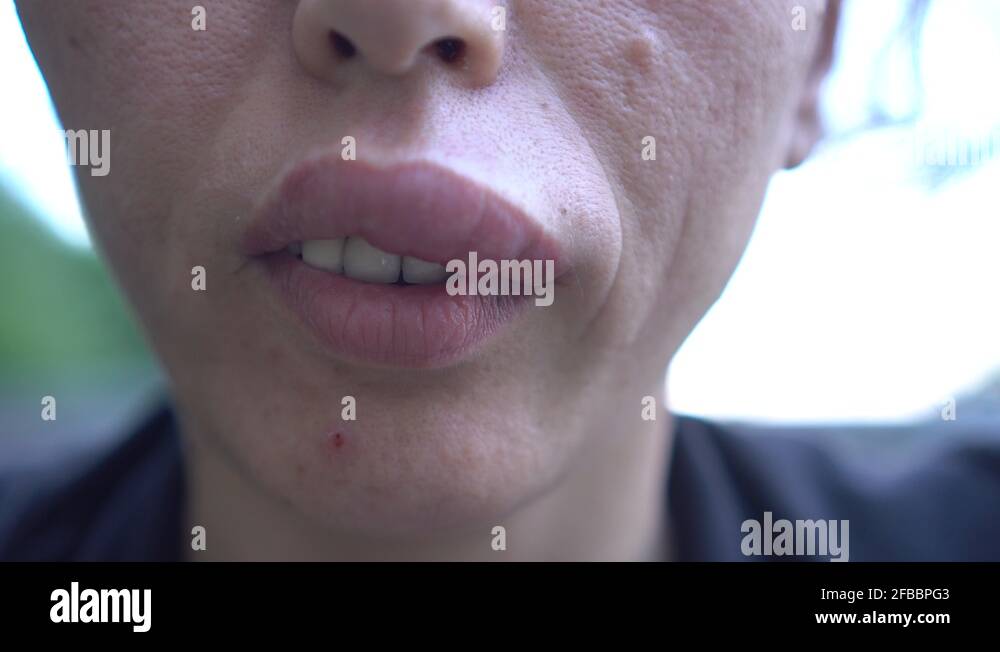 Edema face Stock Videos & Footage - HD and 4K Video Clips - Alamy