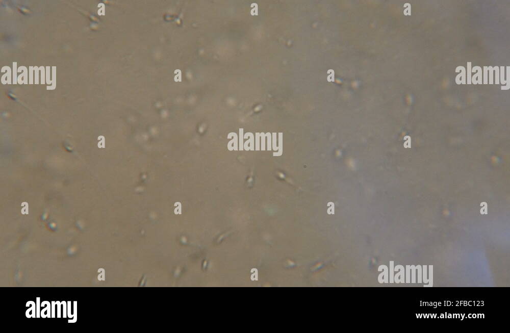 Sperm (spermatozoa) viewed under the microscope. Moving human sperm ...