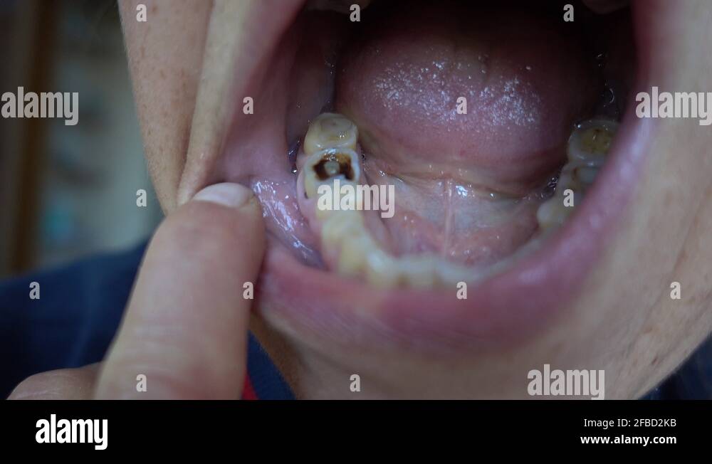Posterior tooth Stock Videos & Footage - HD and 4K Video Clips - Alamy