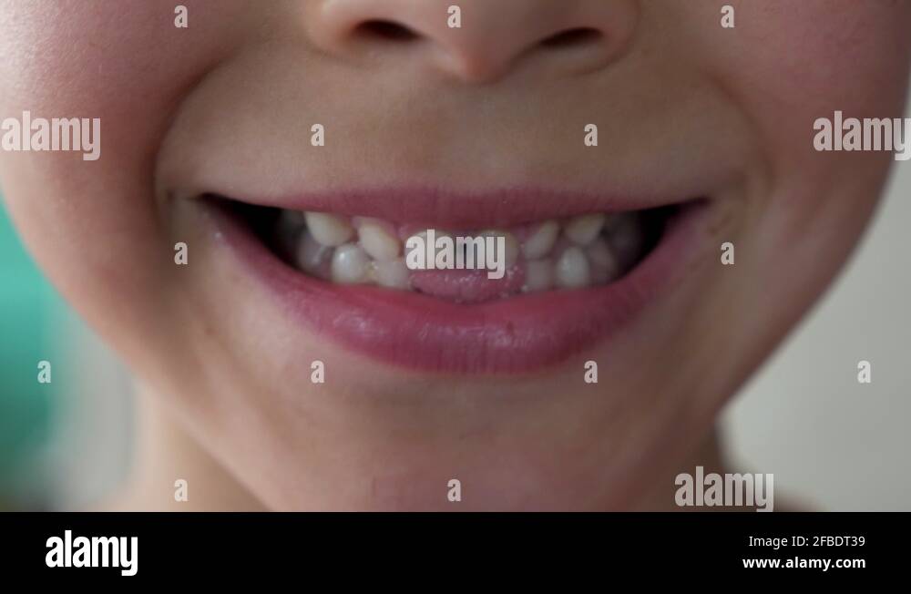 Rotten teeth Stock Videos & Footage - HD and 4K Video Clips - Alamy