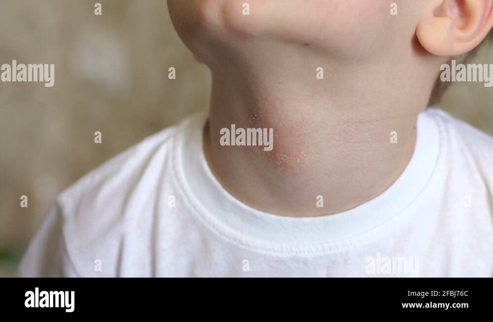 Rash Ringworm Stock Videos And Footage Hd And 4k Video Clips Alamy