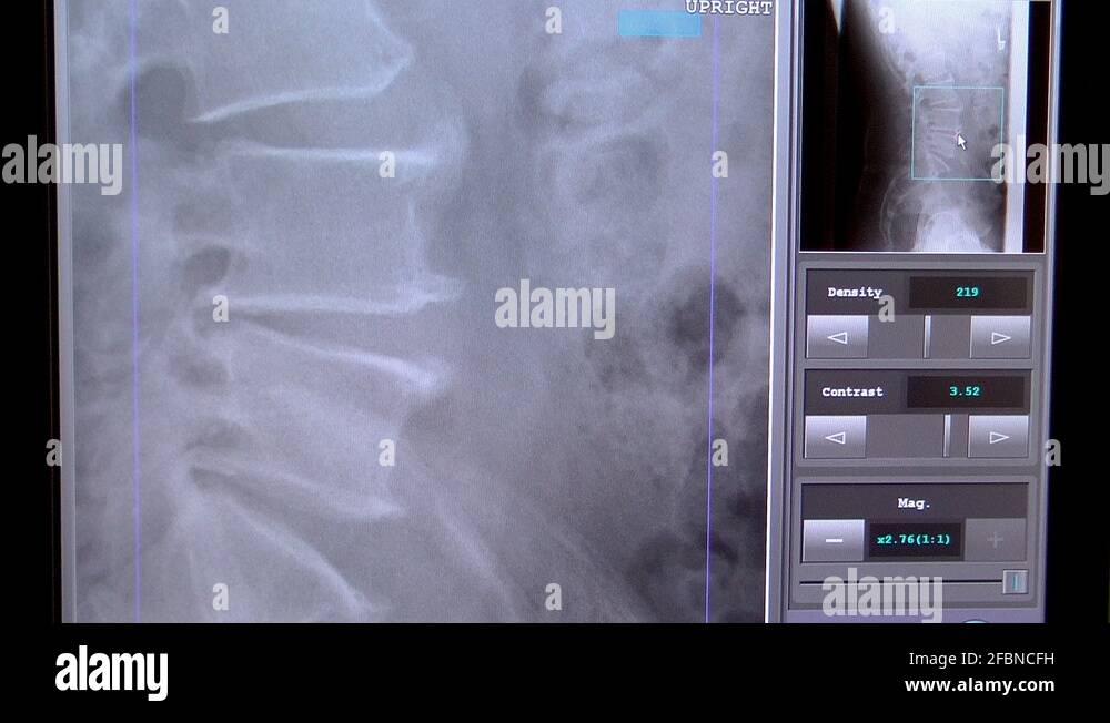 Spinal radiograph Stock Videos & Footage - HD and 4K Video Clips - Alamy