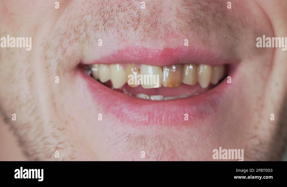 Bad oral hygiene Stock Videos & Footage - HD and 4K Video Clips - Alamy