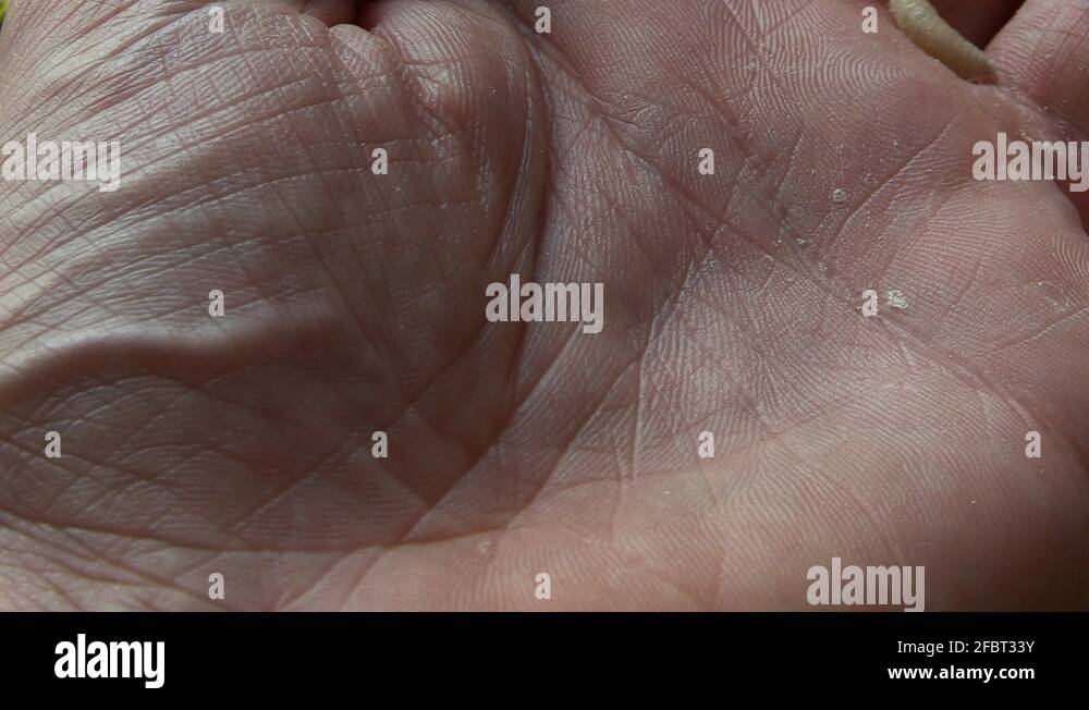 Myiasis Stock Videos & Footage - HD and 4K Video Clips - Alamy