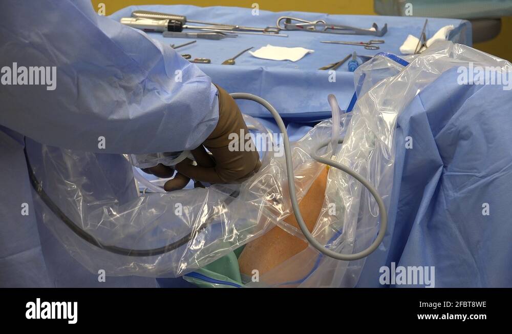 Anterior cruciate ligament reconstruction (ACL reconstruction) is a ...