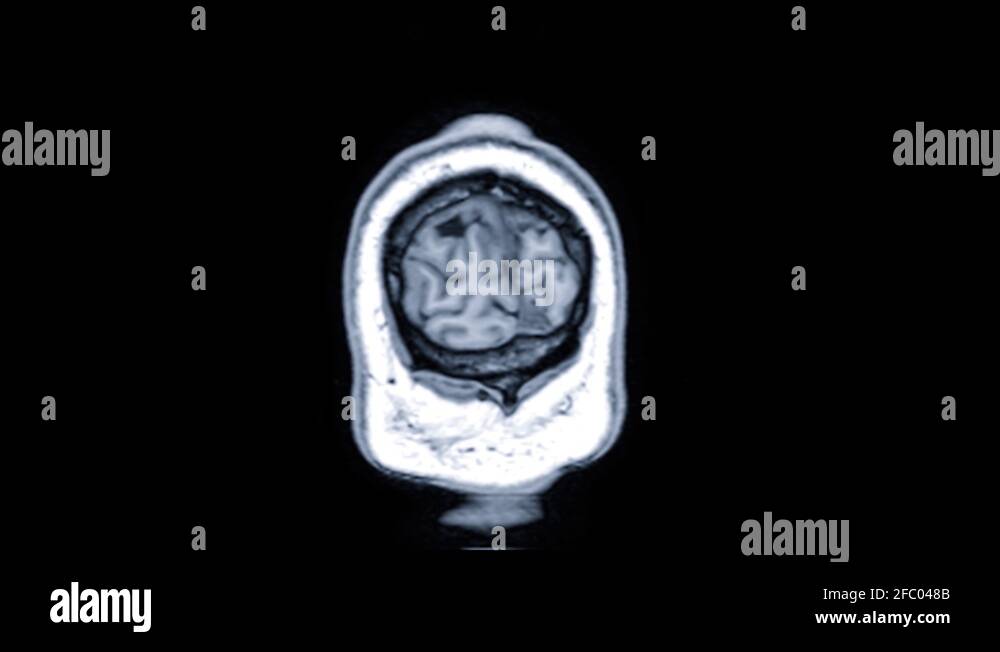Mri scan of back brain Stock Videos & Footage - HD and 4K Video Clips ...