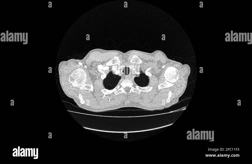 Tuberculosis radiology live MRI scan in x ray film form Stock Video ...
