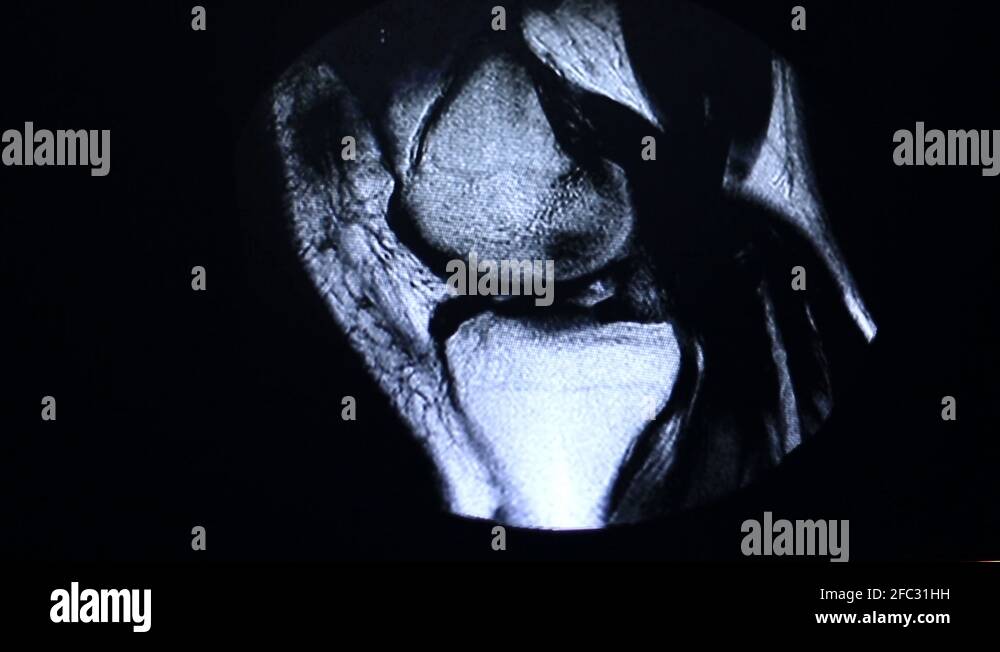 Human Knee Magnetic Resonance Imaging MRI Stock Video Footage - Alamy