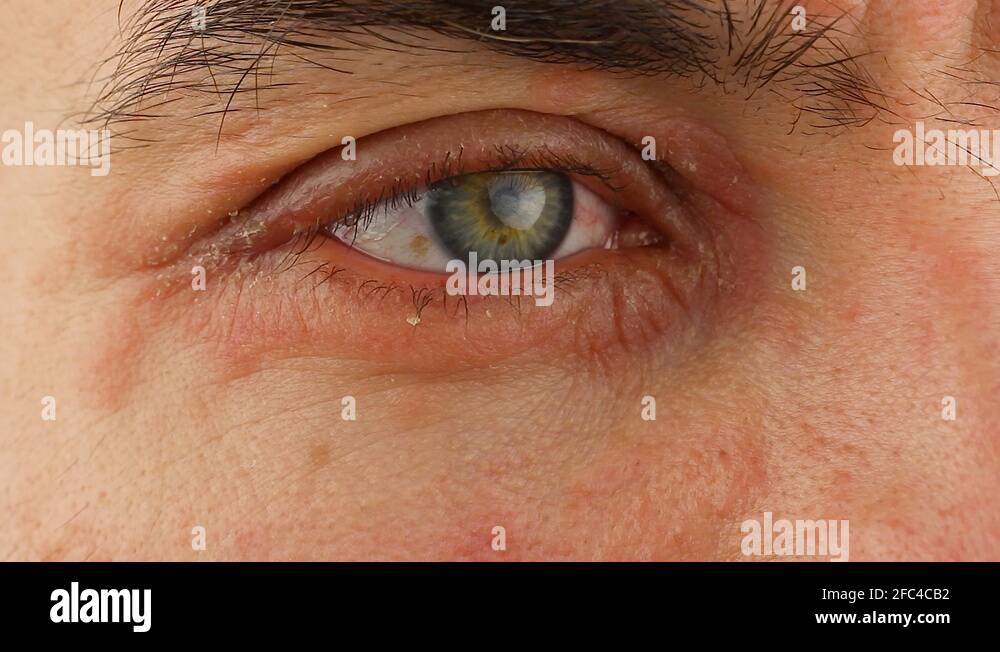 Dry eye symptom Stock Videos & Footage - HD and 4K Video Clips - Alamy