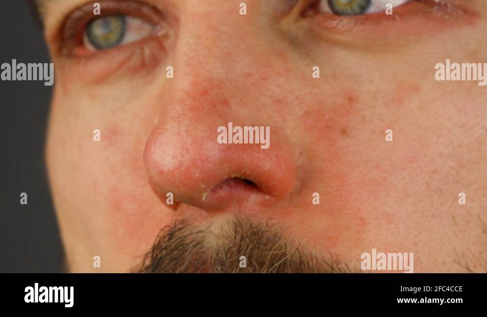 man scratches nose with red allergic psoriasis on skin, dermatology ...