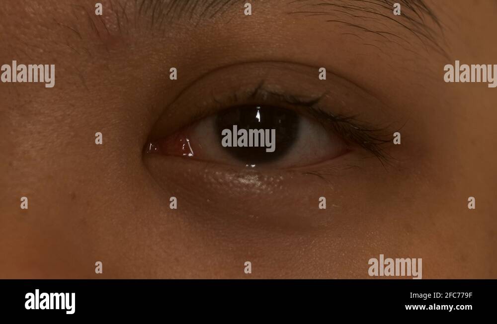 Movements of a brown eye turning every way. Eye has conjunctivitis ...