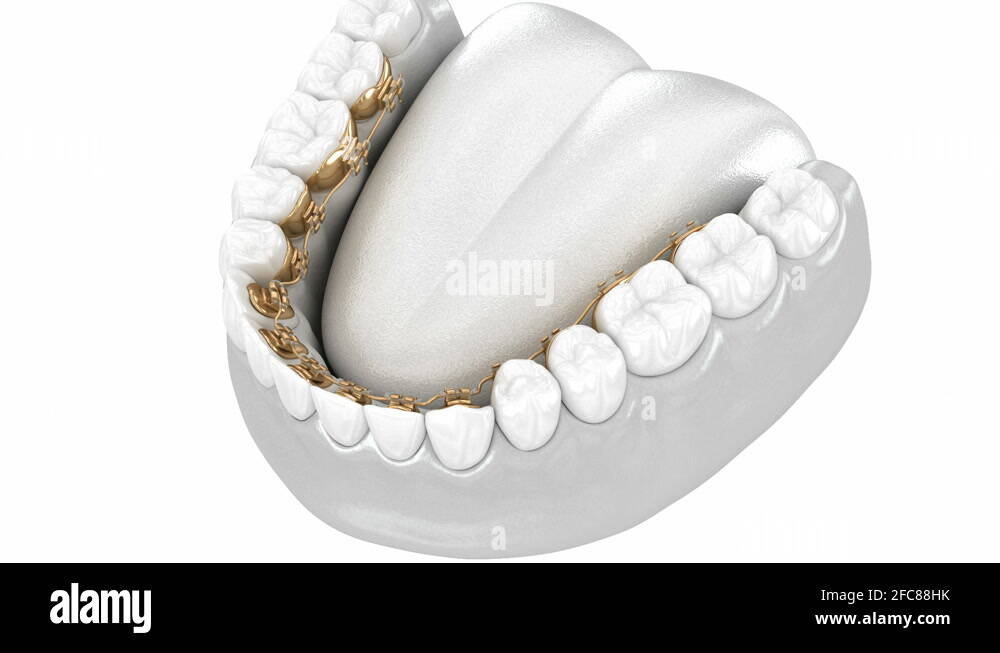 Braces system Stock Videos & Footage - HD and 4K Video Clips - Alamy