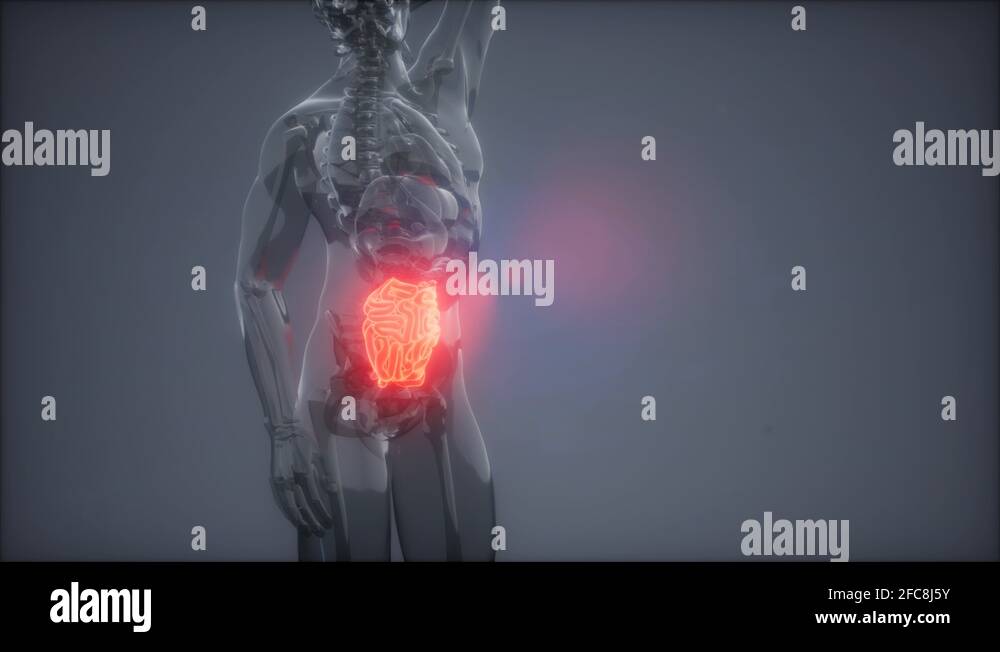 Inflammation small intestine Stock Videos & Footage - HD and 4K Video ...