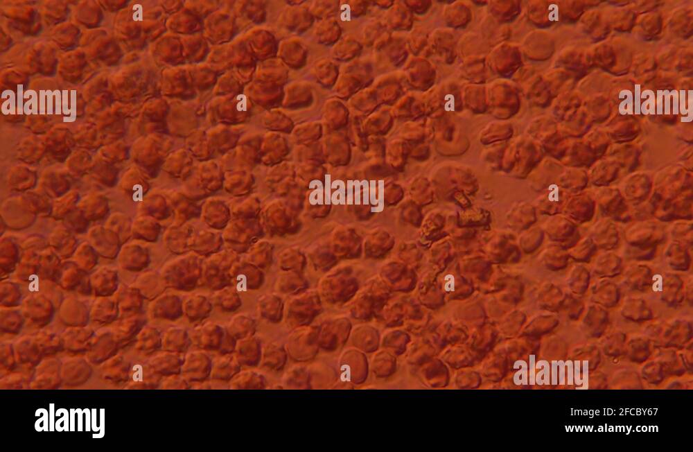 Polycythemia Stock Videos & Footage - HD and 4K Video Clips - Alamy