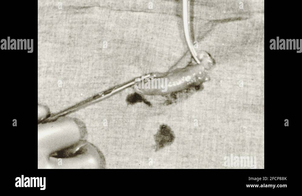 Removed appendix Stock Videos & Footage - HD and 4K Video Clips - Alamy