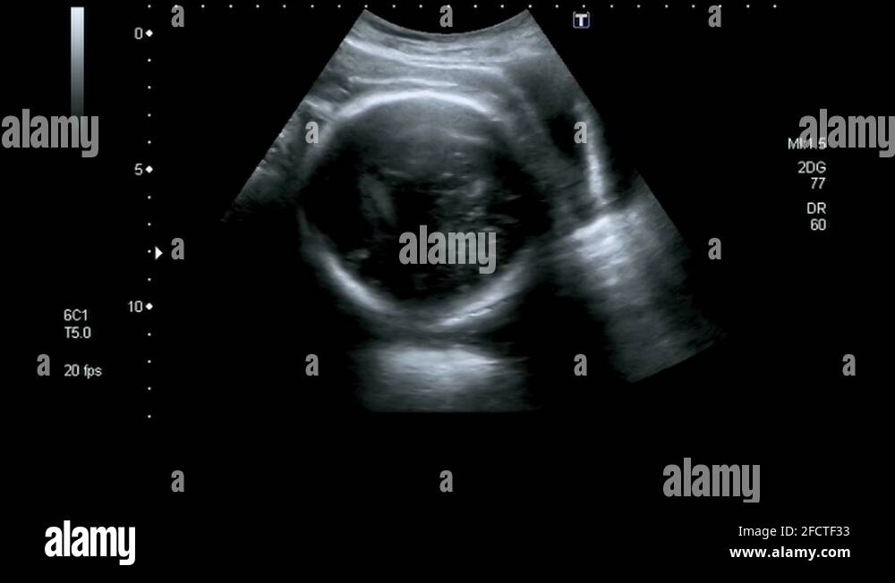 Ultrasound baby development Stock Videos & Footage - HD and 4K Video ...