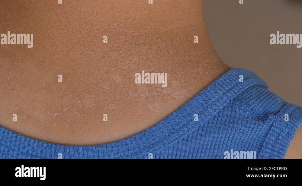 Skin cancer from sun damage Stock Videos & Footage - HD and 4K Video ...