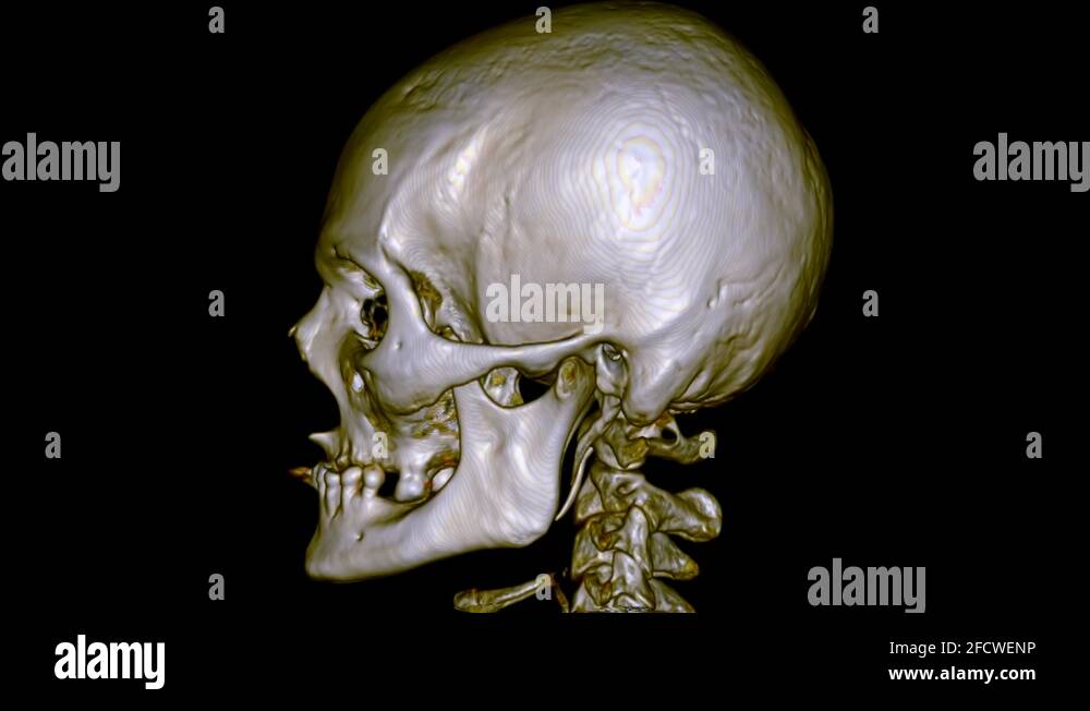 Skull trauma skeleton Stock Videos & Footage - HD and 4K Video Clips ...