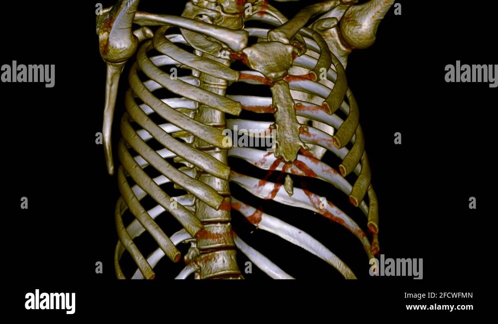 A 3D CT scan of the bones of a male torso, realistic 3D reconstruction ...