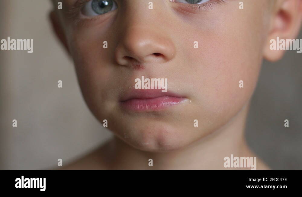 Closeup face of a little boy with a scratched nose. A wound on the face ...