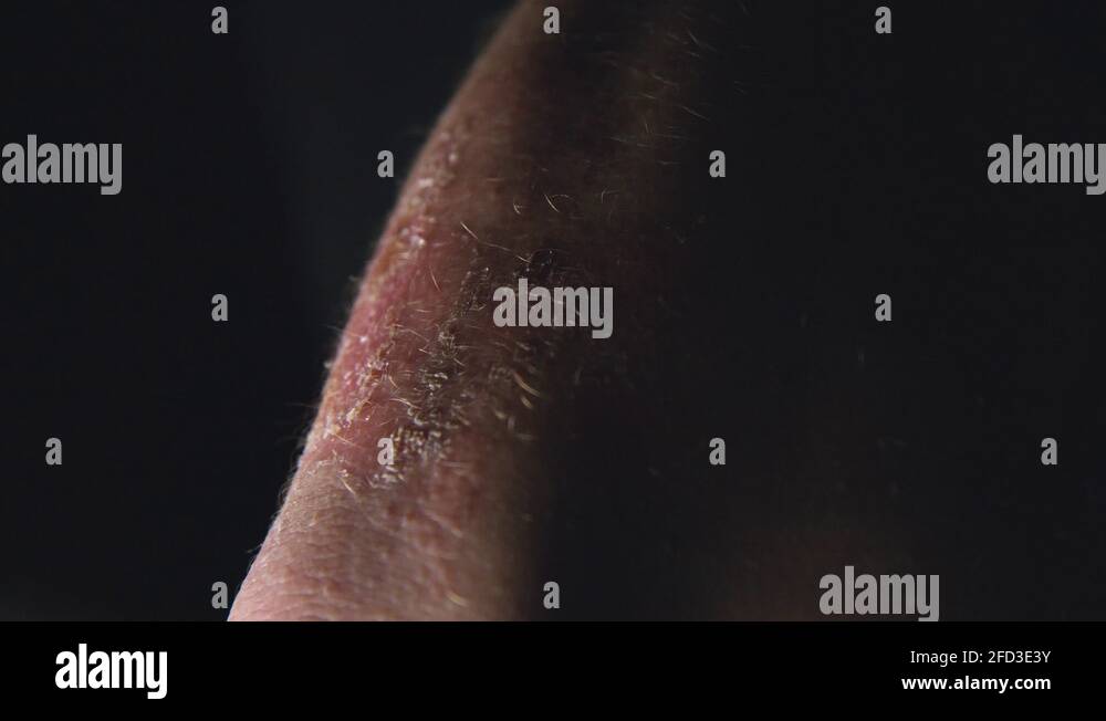 Close up on wound. Dry scab texture. Black background 4k Stock Video ...