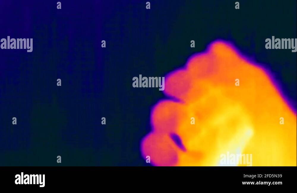 Thermal Infrared Radiation Imaging Of Right Hand With Veins Counting ...