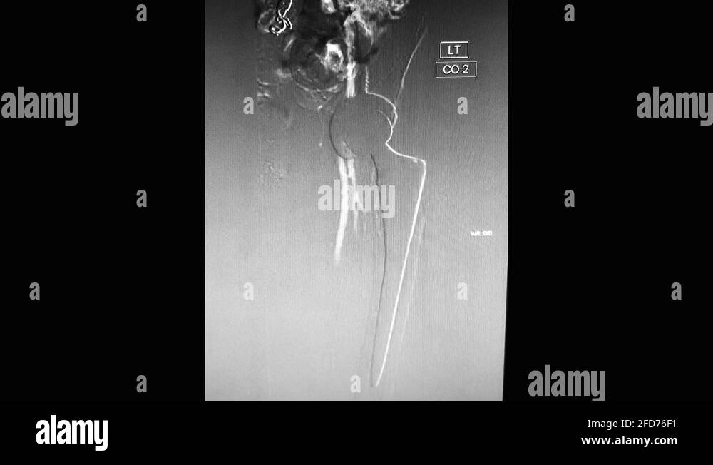 Angiography of left femoral artery with prosthetic left hip Stock Video ...