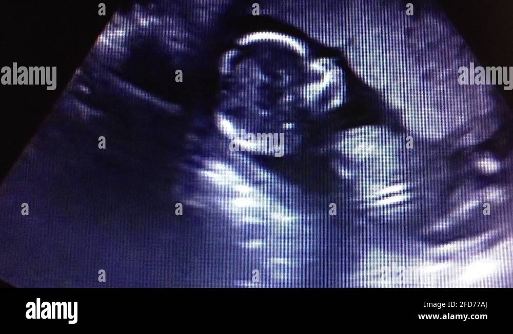 Sonogram of fetus face Stock Videos & Footage - HD and 4K Video Clips ...